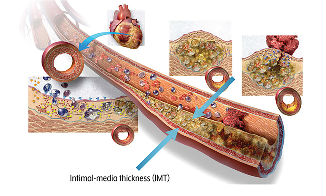 Clinical Basis for IMT - Cypress Heart Health Early Detection